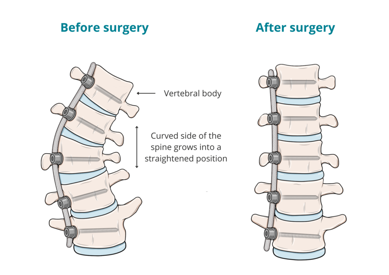 SpineGuard | Complex Deformity