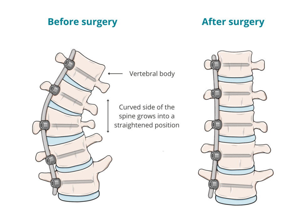 SpineGuard | Complex Deformity