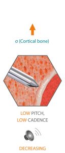 SpineGuard | The DSG Technology to Make Surgery Safer